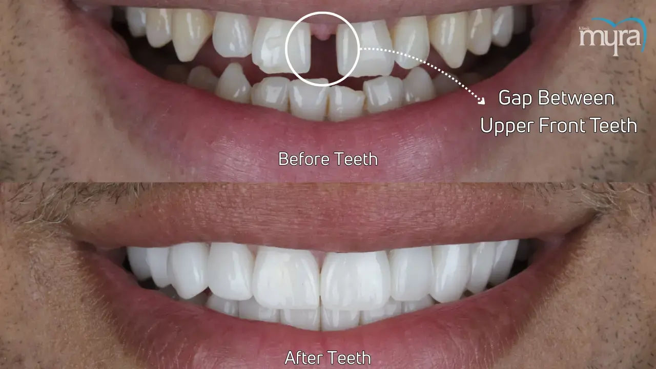 Gap Between Teeth: Symptoms, Treatment, Causes